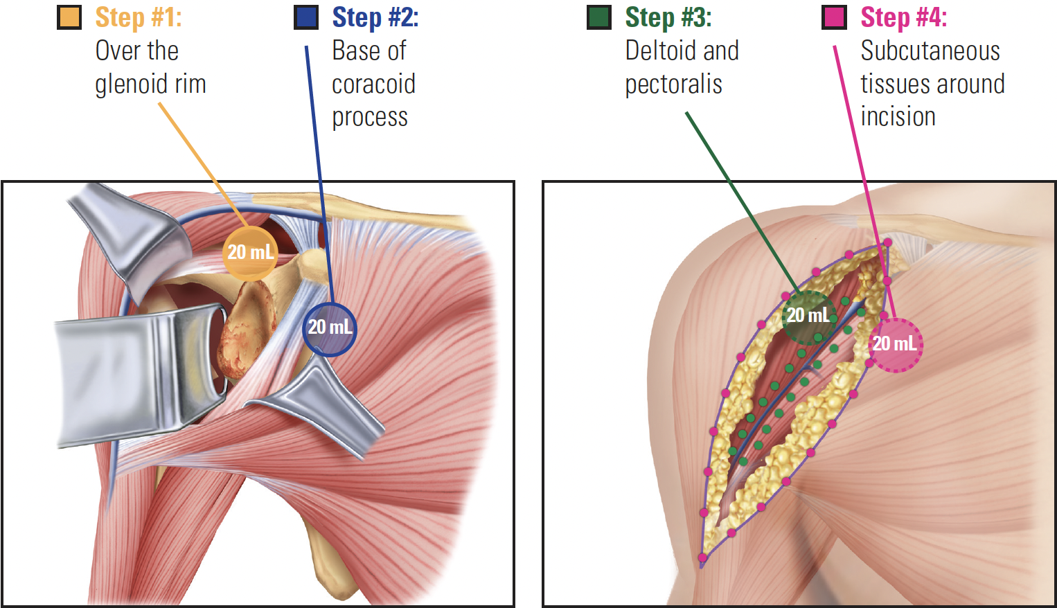 Reverse Total Shoulder Arthroplasty Reverse Total Shoulder Arthroplasty